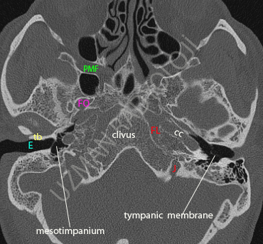 TEMPORAL KEMİK(TEMPORAL BONE) - KAFA TABANI (SKULL BASE) ANATOMİSİ
