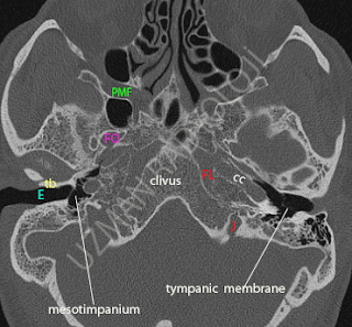 TEMPORAL KEMİK(TEMPORAL BONE) - KAFA TABANI (SKULL BASE) ANATOMİSİ