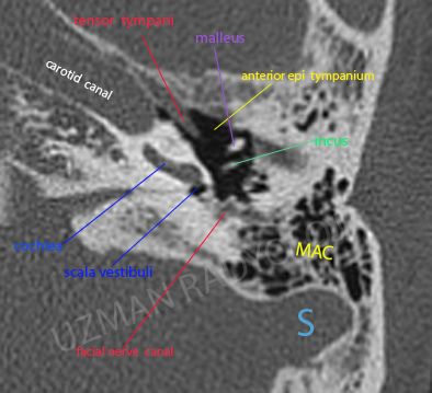 TEMPORAL KEMİK(TEMPORAL BONE) - KAFA TABANI (SKULL BASE) ANATOMİSİ