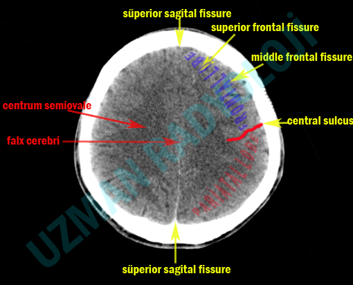 BEYNİN AKSİYEL TOMOGRAFİK ANATOMİSİ (CT OF BRAIN ANATOMI)-I