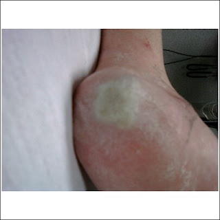 Heel Staph Infection: Sept 13, 2009
