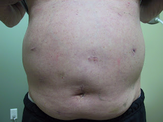 Minimally Invasive Surgery in San Francisco, California: Laparoscopic ...