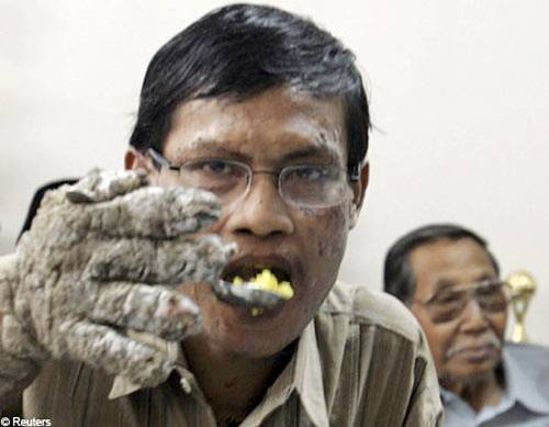 TAMIL-INDIAN: Tree man