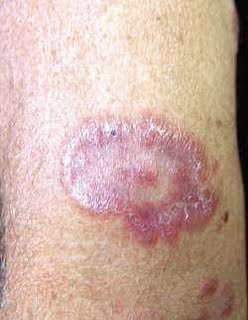 DST. Previna-se: Sífilis