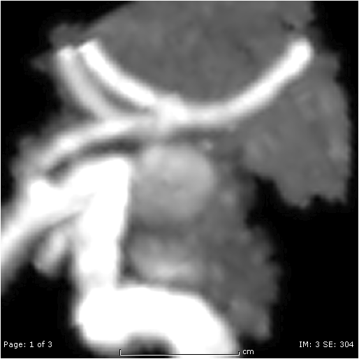 Mindys MRI procedures blog: Aneurysm COW