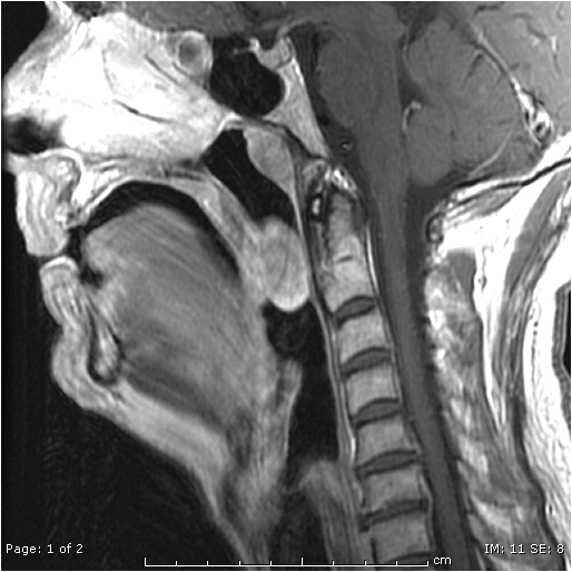 Mindys MRI procedures blog: MRI Trachea Tumor