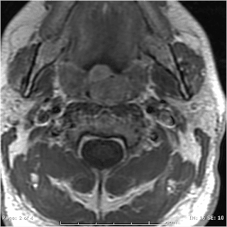 Mindys MRI procedures blog: MRI Trachea Tumor