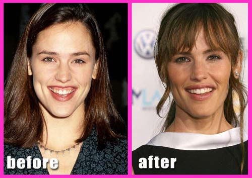 Plastic Surgery Before After: Jennifer Garner Plastic Surgery