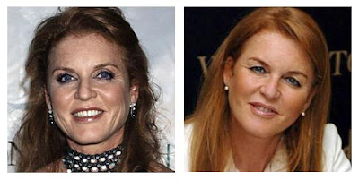 Plastic Surgery Before After: Sarah Ferguson Plastic Surgery