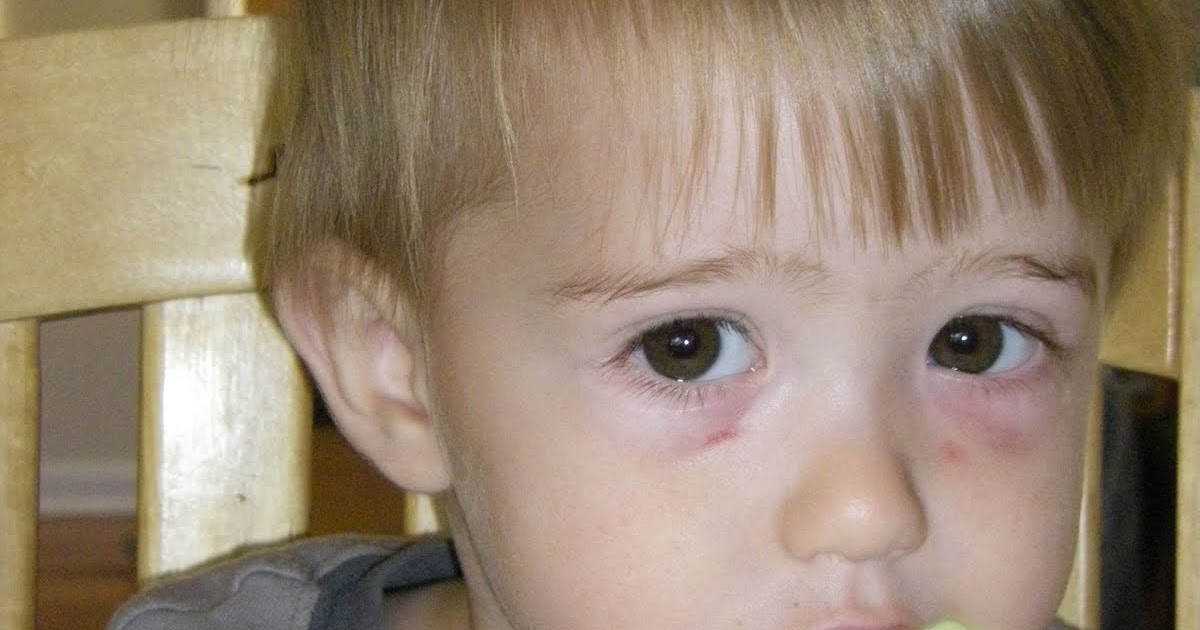 On Being, Nourished and Shrinking: Allergic Shiners