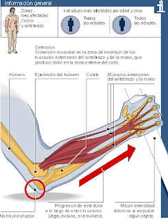 Codo de tenista (epicondilitis lateral) : Super Pádel