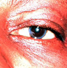 Clinical signs in medicine: Xanthomas