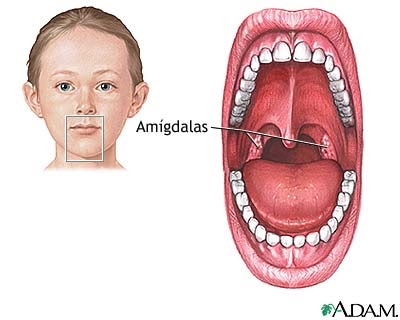 MediGuia: Faringoamigdalitis