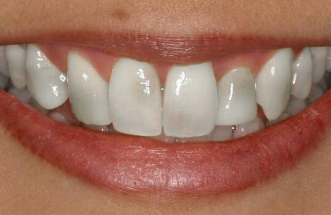 Catherine Nault: c'est facile avoir les dents blanches