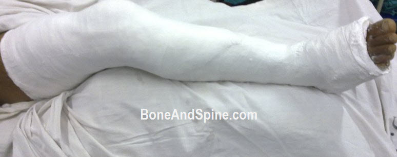 Pharmacy practice: Plaster cast and Splint