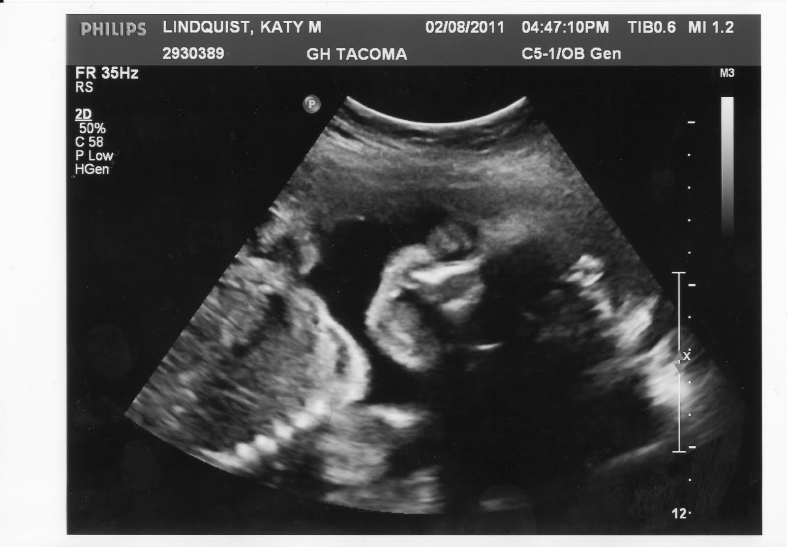 the lindquist four: 26 week ultasound