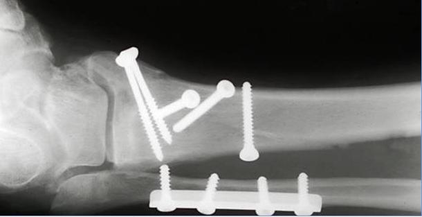 Health & Medicine: What Happens to Broken Bones