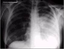 Krizia Cruz: PESTE NEUMONICA