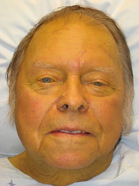 Yellow skin discoloration - Causes of yellow skin color | the dynamic ...