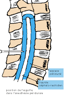 Voilà bébé: La péridurale