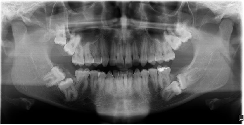Pediatric Dentistry: Interesting Eruption Pattern