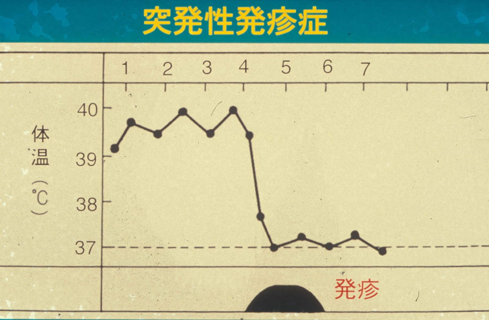 Kami-Ube Pediatric Clinic: Exanthema subitum( Roseola)