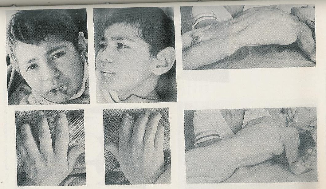 Síndrome de Lesch Nyhan: Síndrome de Lesch-Nyhan