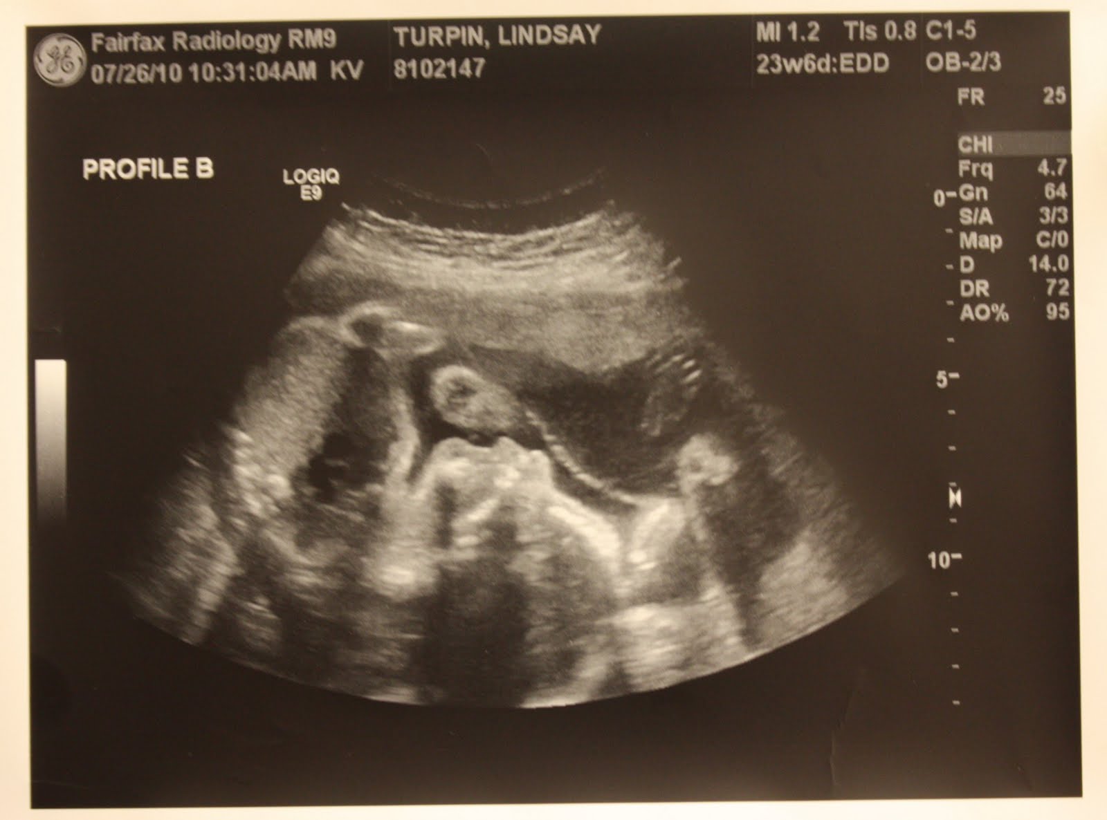 Adventures in Baby Making: Week 24 Ultrasound
