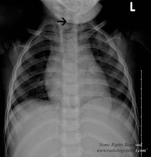 RiT radiology: Evaluate level of lung inflation in pediatric chest film