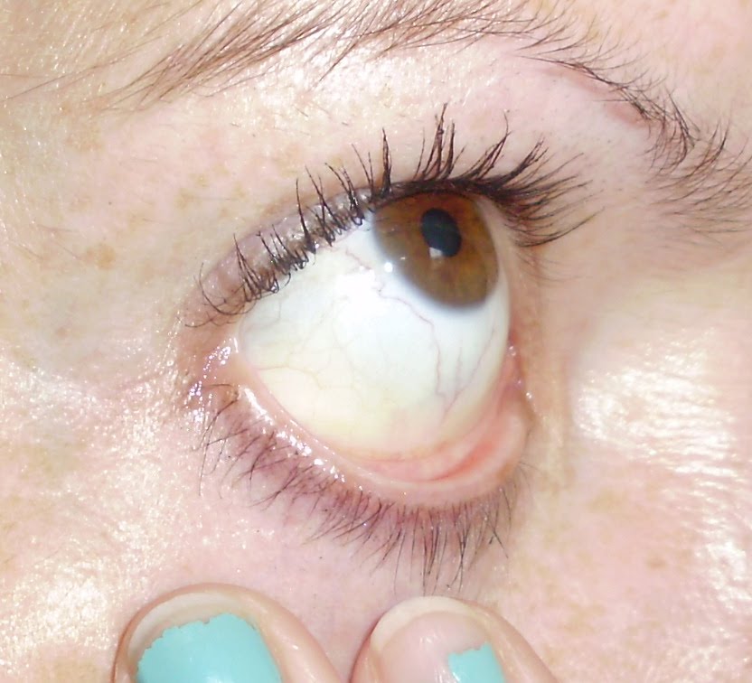 finnjonna: ett öga rött