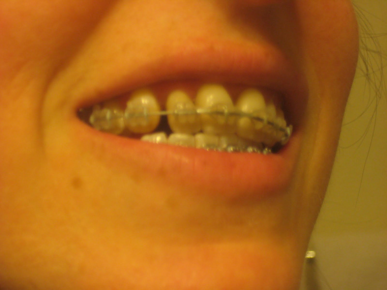 SARPE, Jaw Surgery and Adult Braces, Oh My!: 4 months of braces!