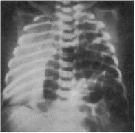 SiMaRoNeT: ENFERMEDAD DE LA MEMBRANA HIALINA