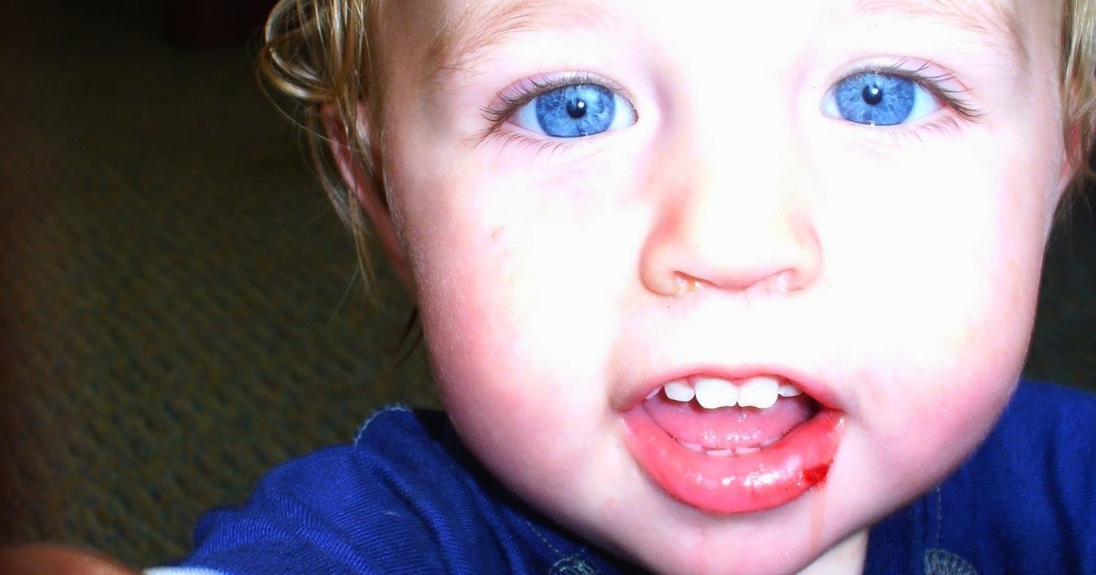 Project Mommyhood: Stitches in Time.....or rather....Stitches in Lip