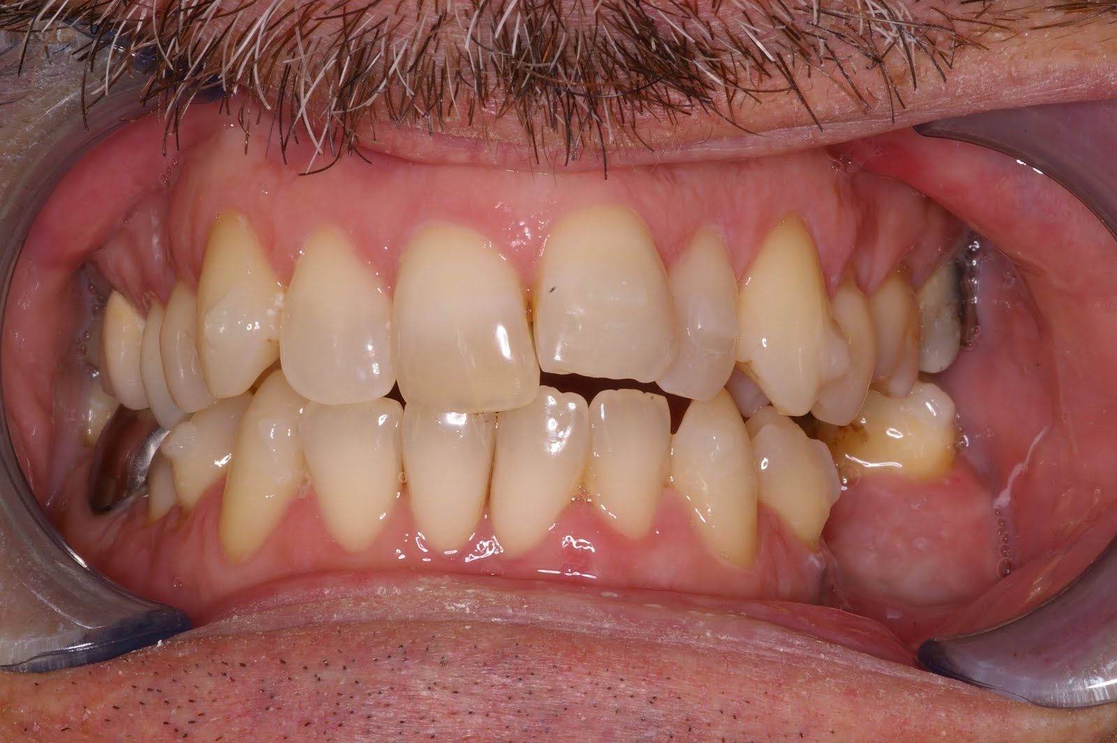 Cosmetic Dentistry and Invisalign: Invisalign first visit