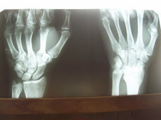 ---RAYOS X 2010--- =): Muñeca:proyección PA