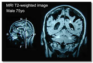 Neurology Minutiae: Diagnostic criteria for FXTAS (fragile x associated ...