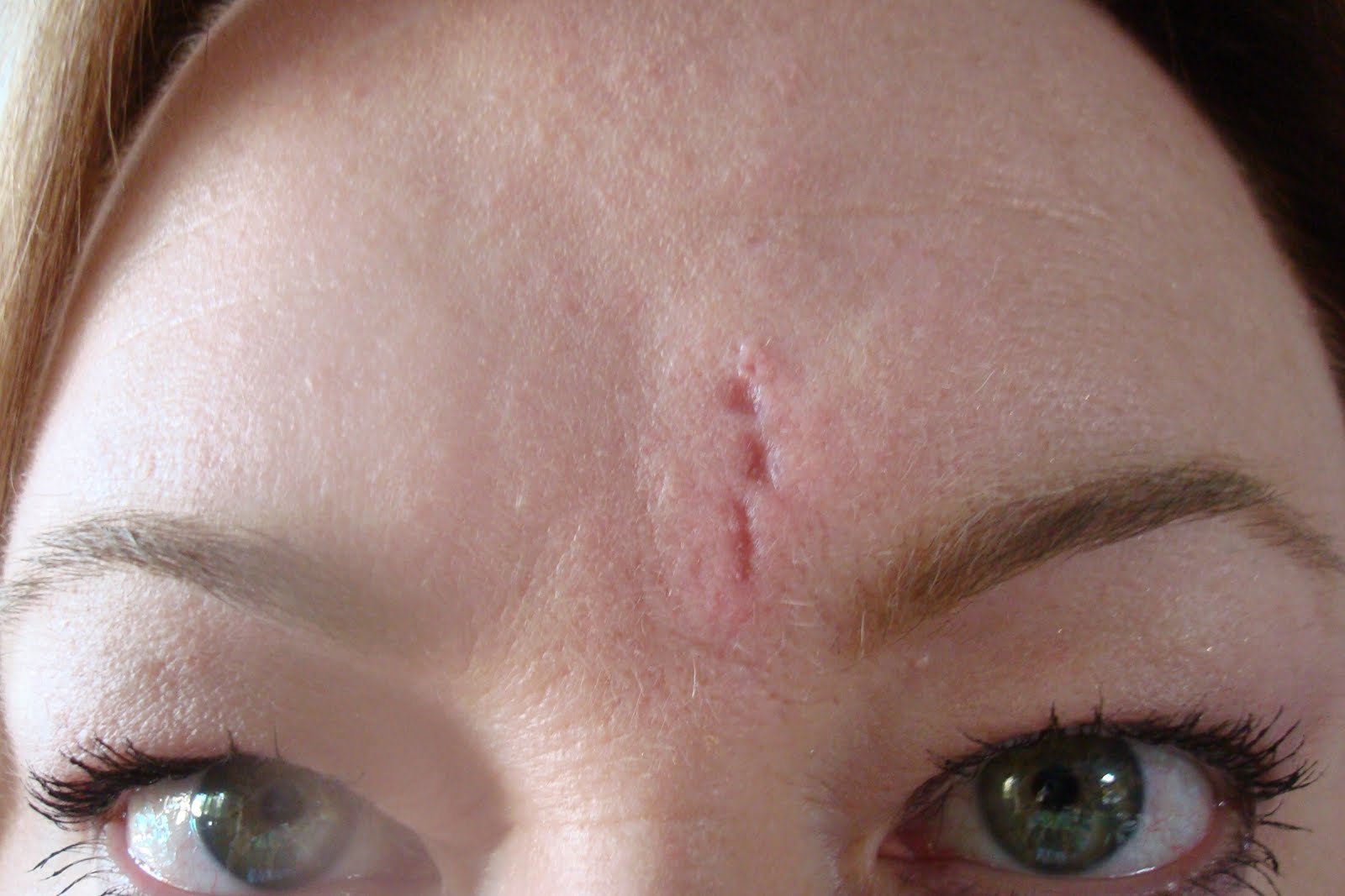 Spider Bite On Forehead