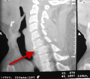 DR. GUSTAVO ESPINOSA: COLUMNA CERVICAL