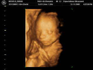 The Nichols Family: 3d/4d Ultrasound 22 Weeks!