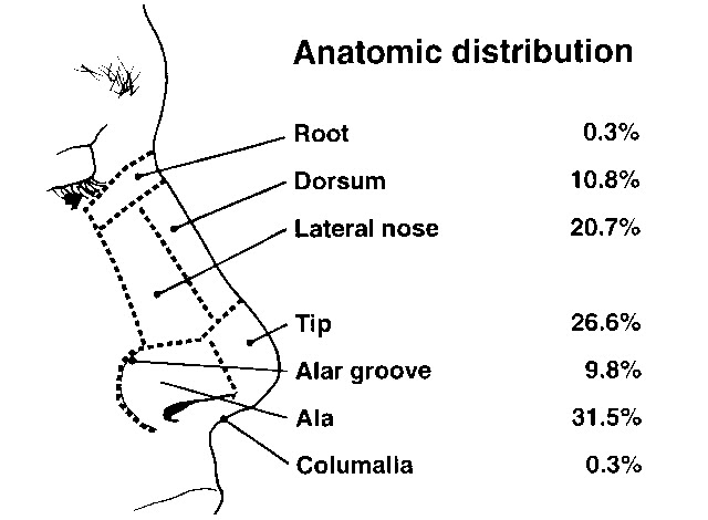 Shield Graft: Nomenclature of nose: This could be especially helpful to ...