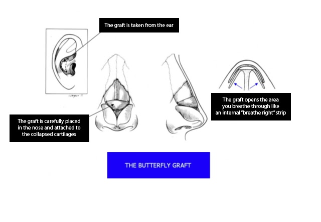 Nose Revision Surgery and Surgeons: The mystery of all the different ...