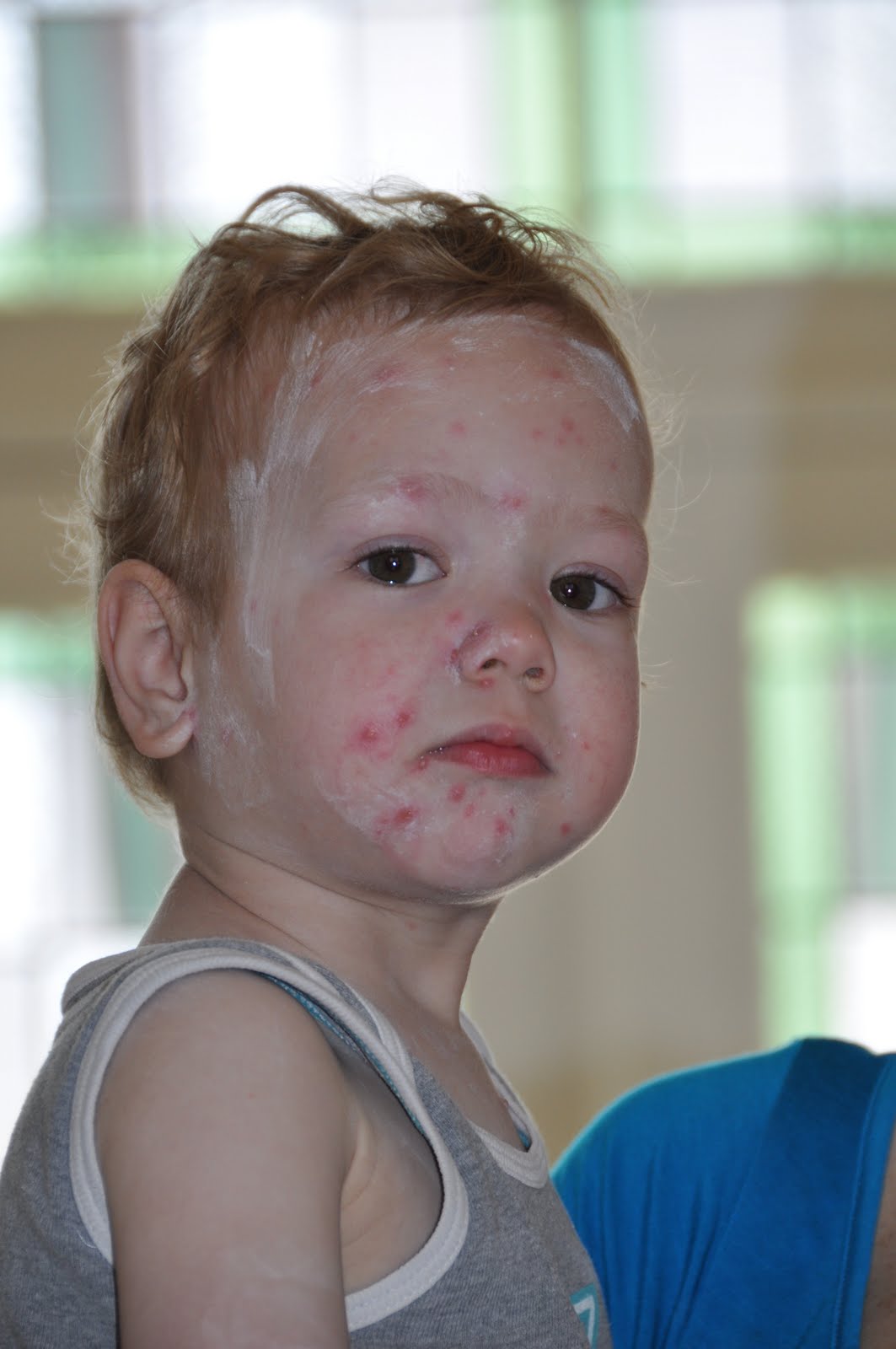 Quinten-Aiko: Windpokken