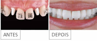 Odontologos,profissionais de sucesso: Estética para ter dentes mais ...