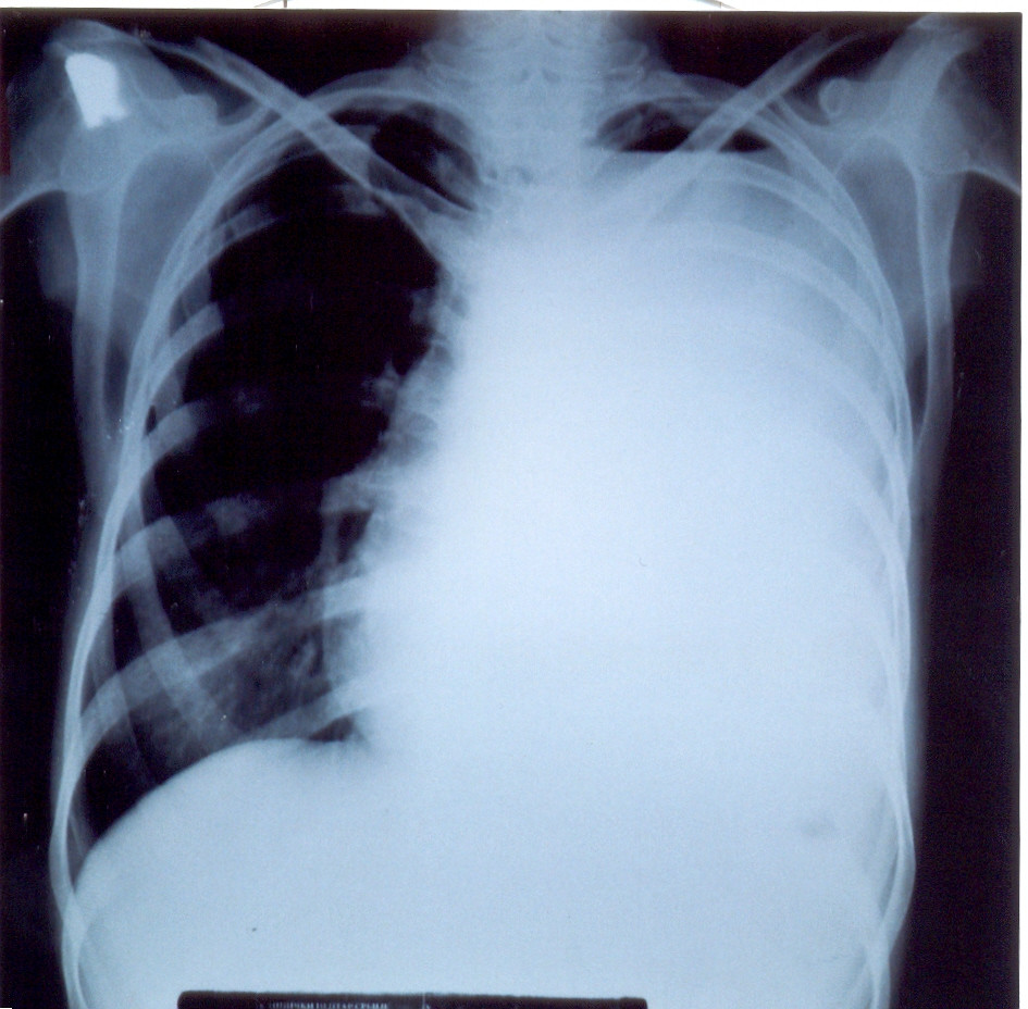 mynsgnotes.blogspot.com: Hydropneumothorax
