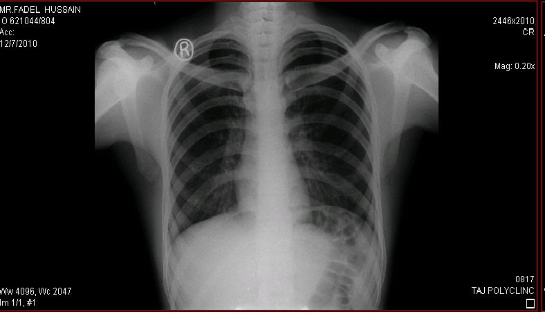 mynsgnotes.blogspot.com: Hydropneumothorax