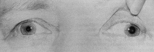 mynsgnotes.blogspot.com: Diplopia (Double Vision)