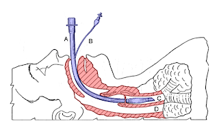 Respiratory Therapy: Intubation (ETT, Endotracheal tube)