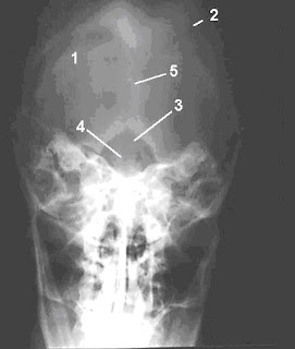 Dr.Sharath's Blog: Townes view