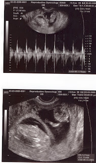 Life with Twin Boys: Ultrasound pictures at 11 weeks 3 days