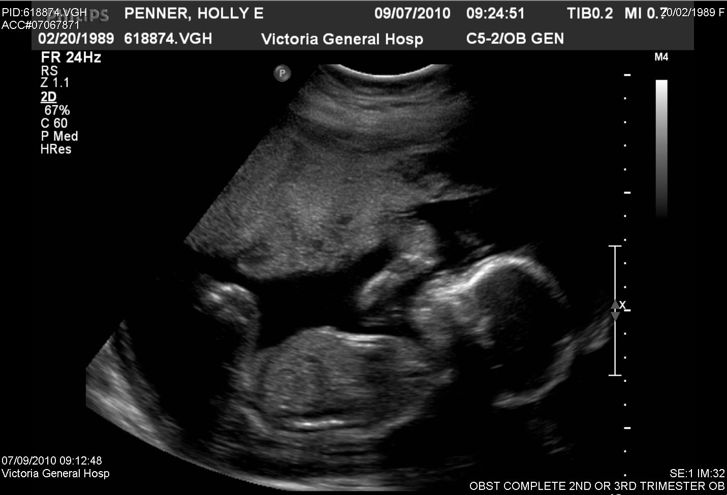 Journey to You: Ultrasound Pictures from 21 Weeks 1 Day